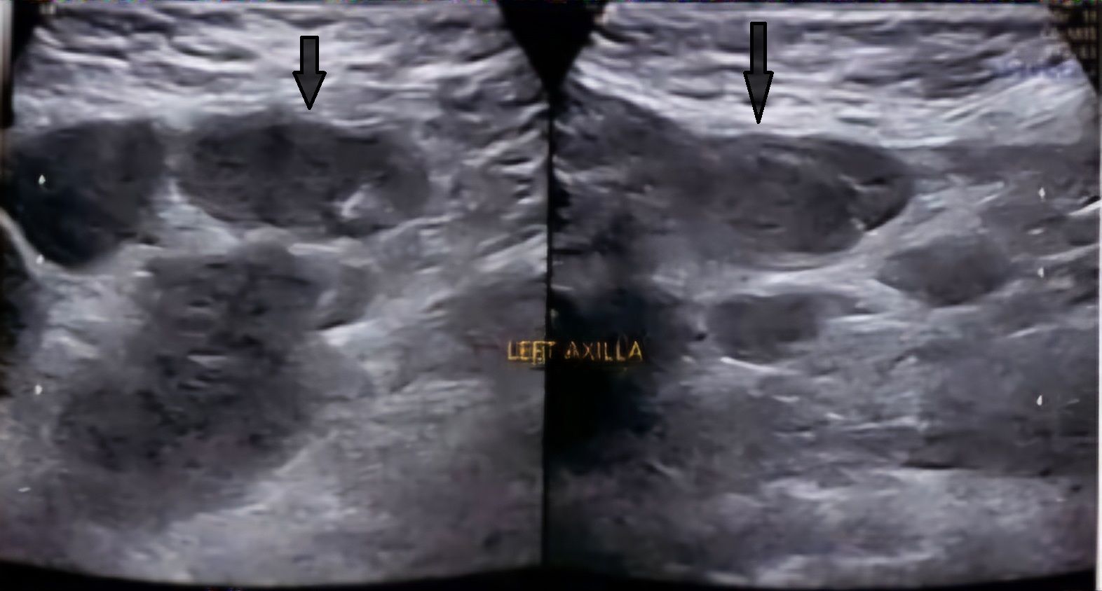 Research - Isolated Axillary Lymphadenitis : A tale of Extrapulmonary ...